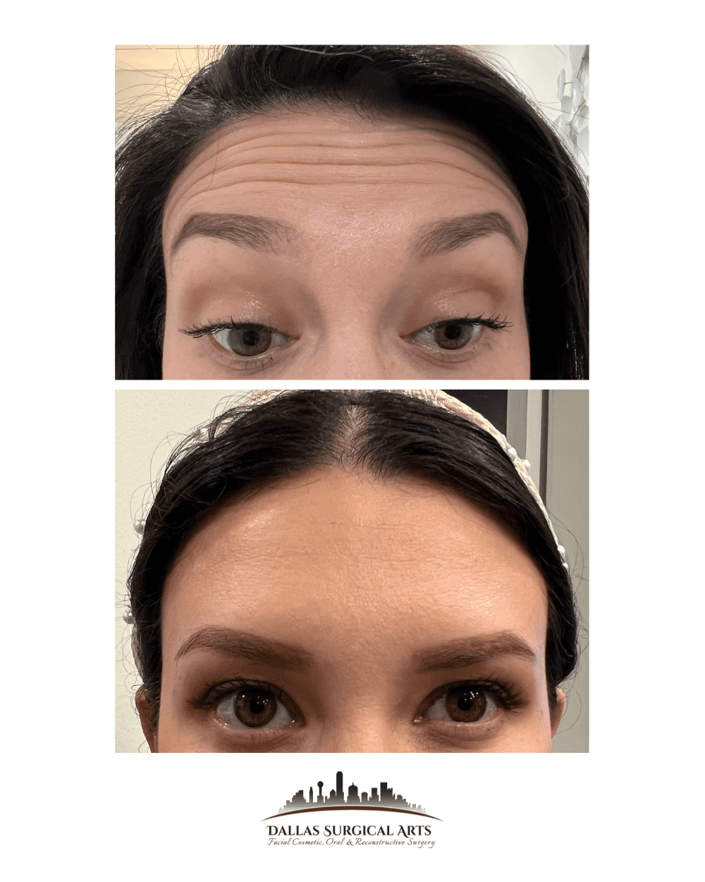 Botox | Dallas Oral Surgery